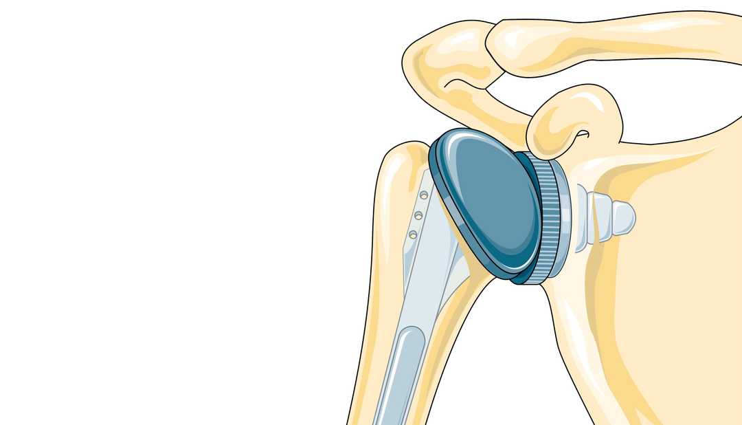 Prothèse de l’épaule à Paris : Opération et résultat - Dr Roure
